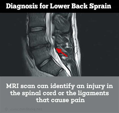 Back Sprain Strain Causes Symptoms Diagnosis Treatment Prevention