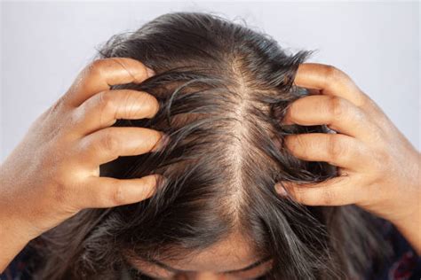 Scalp Diseases Ramaiah Ayurveda Hospital