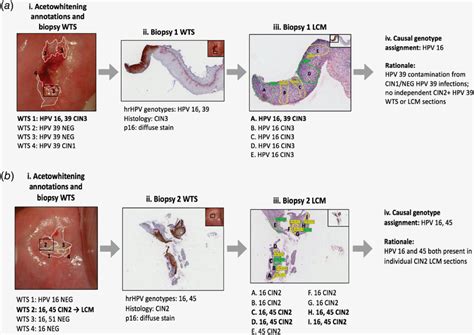 Process For Attributing Hpv Genotypes To Cervical Lesions A Process