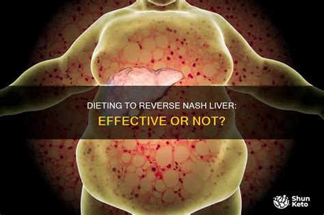 Dieting To Reverse Nash Liver Effective Or Not Shunketo