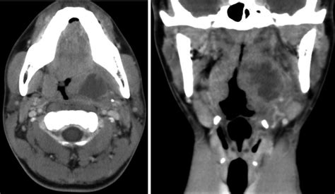 Contrast‐enhanced Computed Tomography Ct Of The Lateral Side Of The Download Scientific