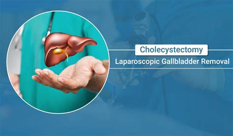 Laparoscopic Gallbladder Removal Laparoscopic Gallbladder Removal