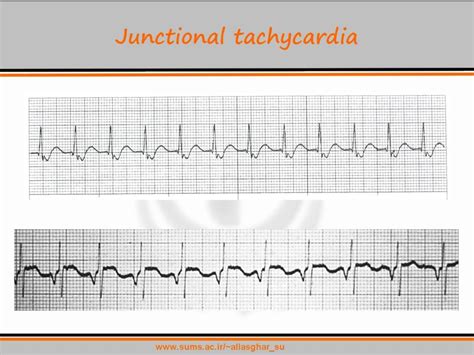 Ppt A Review Of Basic Heart Rhythms For Nursing Staff Session 4