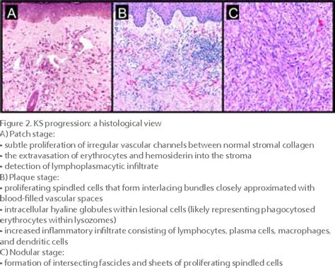 Kaposi Sarcoma Histology Diagram