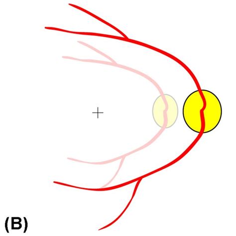 Examples Of Rnfl Deviation Map Including Coordinates Of Disc Center And