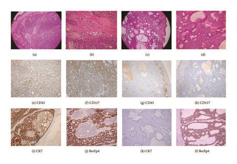 Primer Cutaneous Adenoid Cystic Carcinoma Pcacc Left Two Columns