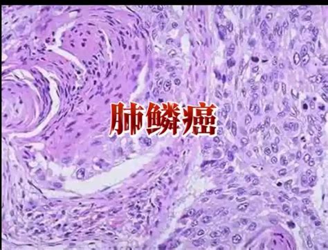 50岁女子恶心胃镜正常，确诊癌症后医生叹息：被这个检查耽误了 知乎