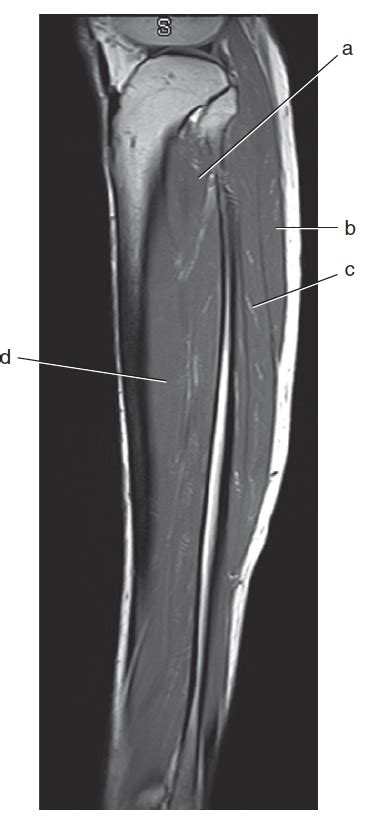 Diagram Of Sagittal Mri Of Lower Leg Quizlet