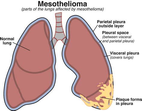 Mesothelioma Long Lasting And Hard To Detect News Sports Jobs