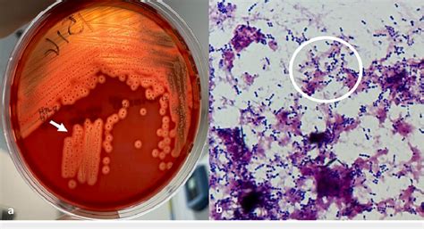 Cultures Of Peripheral Blood A Beta Hemolytic Large Colony Of