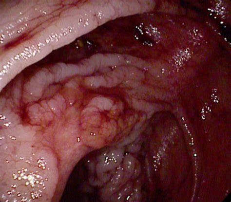 Invasive Amöbiasis Im Kolon Endoscopy Campus