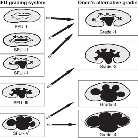 Comparison Of Sfu And Onens Hydronephrosis Grading System Ags