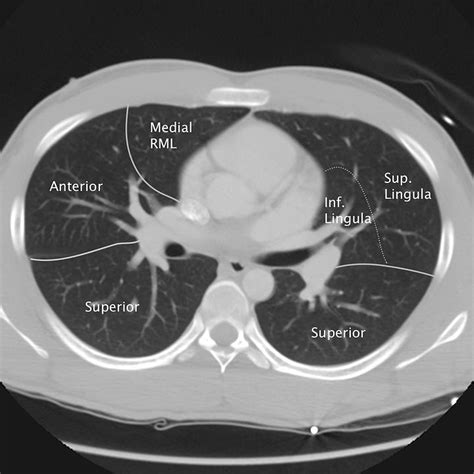 Chest Anatomy Radiographs And Ct By Alexander Baxter