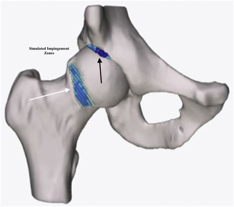 Management Of Bone Marrow Lesions Of The Hip With Subchondral Calcium Phosphate Injection