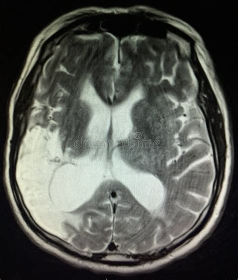 Infarto Cerebral Agudo Resonancia Magnética Ictus Imagen De Archivo