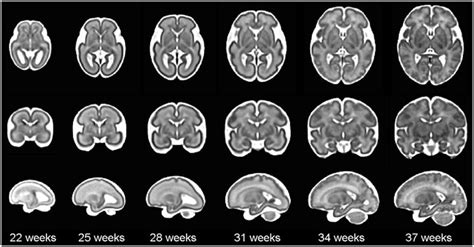 A Normative Spatiotemporal Mri Atlas Of The Fetal Brain For Automatic