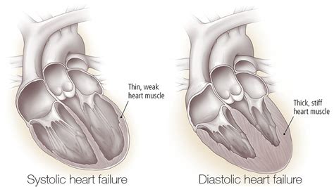 Does Preserved Lv Function Mean Heart Failure