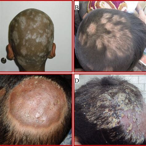 Tinea Capitis Presentation In Xinjiang A Tinea Capitis “white Tinea