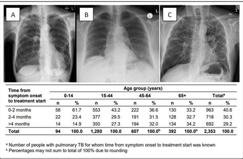 When To Consider Tuberculosis Bronchiectasis In The Elderly Population