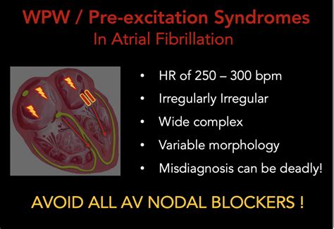 Atrial Fibrillation With Wpw Ecg Weekly