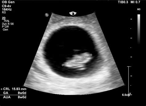 Echo 15 Weken 3 Dagen Rome