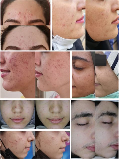 Evaluation Of The Effectiveness Of Berberis Integerrima Bunge Root Extract Combined With