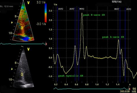 Strain Strain Rate And Speckle Tracking Myocardial Deformation The