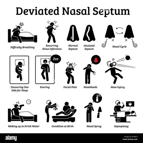 Deviated Nasal Septum Stock Vector Images Alamy