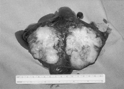 Cryptococcus Infection In Tropical Australia Pmc
