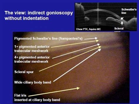 Gonioscopy