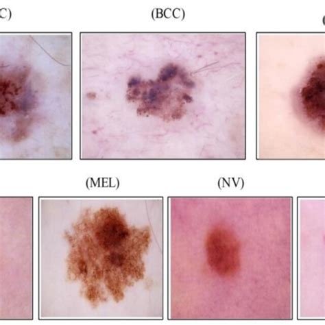Sample Skin Lesion Types Collected From The Ham10000 Dataset [20