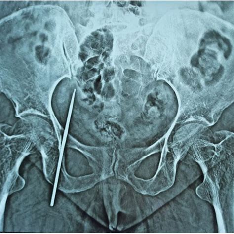 X Ray Pelvis Showing A Linear Radio Opaque Shadow In The Right