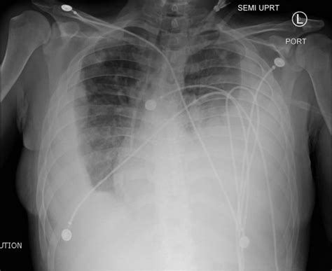 Endocarditis Cxr Jetem 2018 Jetem
