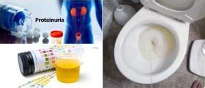 Proteinuria ¿qué Es Tipos Síntomas Causas Diagnóstico Y Tratamiento