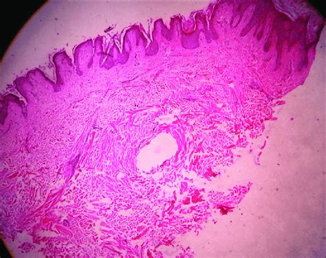 Histopathology Showing Papillomatosis Dense Collagen Bundles In The