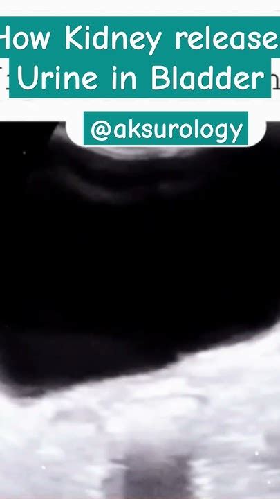 Uvj Is Junction Of Ureter With Bladder Youtube