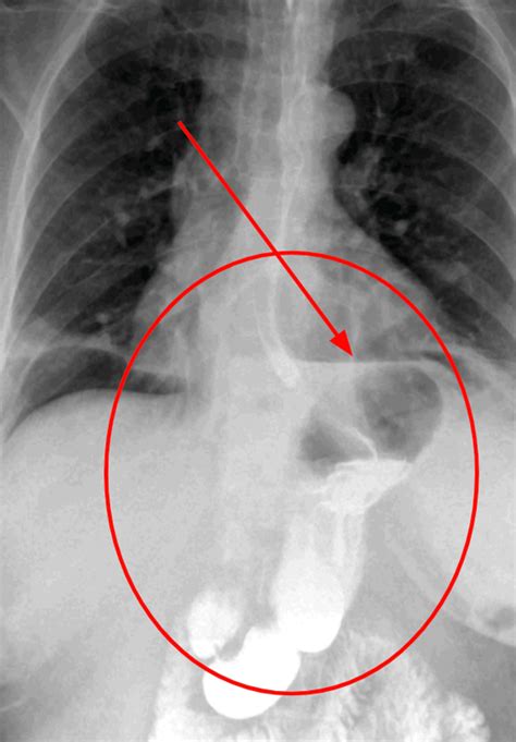 Gastric Volvulus As A Complication Of Giant Hiatal Hernia A Case