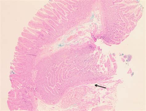 Scielo Brasil Duodenal Duplication Cyst With Enteroliths Diagnosed By Echoendoscopy And