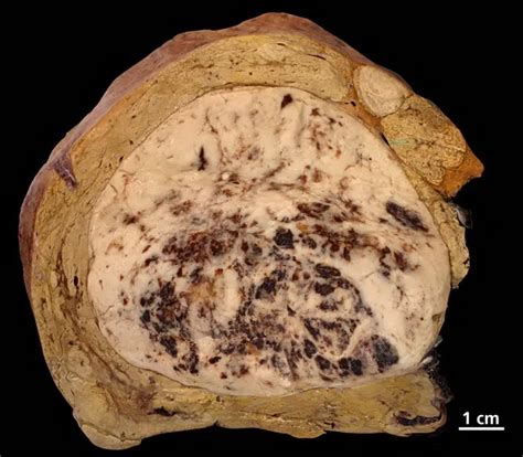 Liver Cell Adenoma Telangiectatic Type