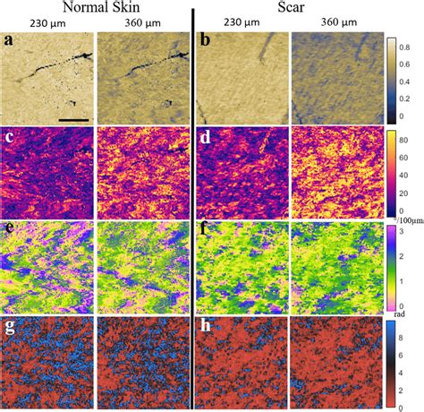 Comparison Between Normal And Fibrotic Human Forearm Skin At Two