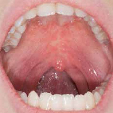 Submucous Cleft Palate