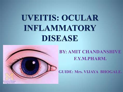 Uveitis Ppt Pptx