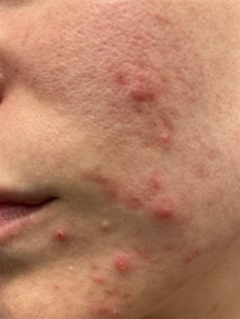 30f Does Differin Have The Same Anti Aging Benefits As Tretinoin I