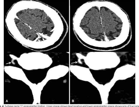 Figure 4 From A Case Of Rotational Vertebral Artery Syndrome After Vertebral Artery Dissection