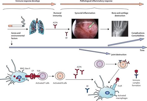 Rheumatoid Arthritis The Lancet