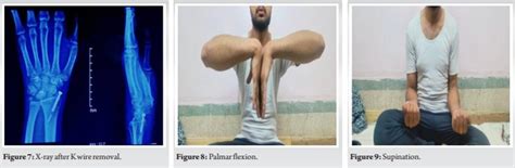 Volar Lunate Dislocation A Case Report Journal Of Orthopaedic Case