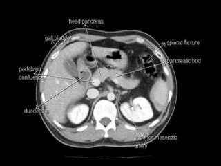 Ct Abdomen Anatomy Ppt