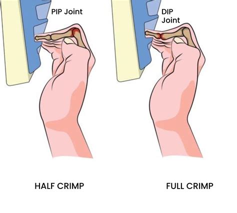 Management Of Swollen Knuckles For Climbers Evolution Pt