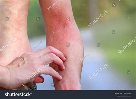 Rashes From Wooly Worms