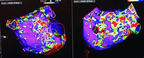 Left Atrial Voltage Recorded Left Atrial Voltage The Color Scale For